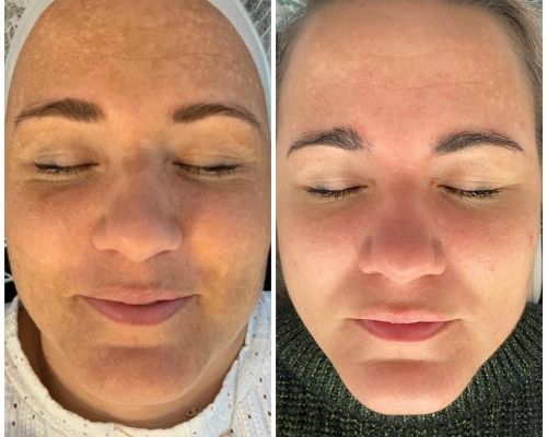 Algen Peeling tegen pigmentvlekken