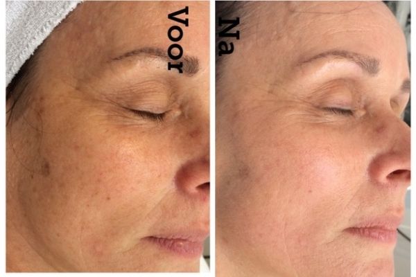 Algen Peeling tegen pigmentvlekken